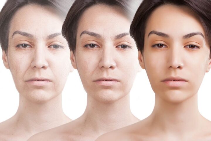 Is Ellanse Filler Safe?