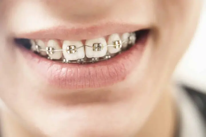 Is It Normal To Be Scared To Get Braces?